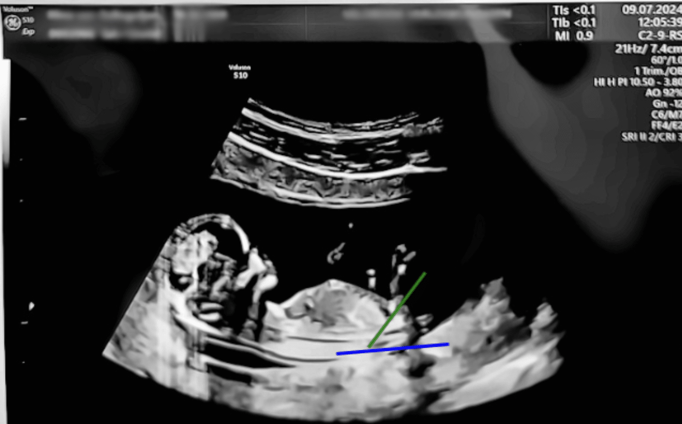 De nub-theorie: kun je zo het geslacht van je baby voorspellen?