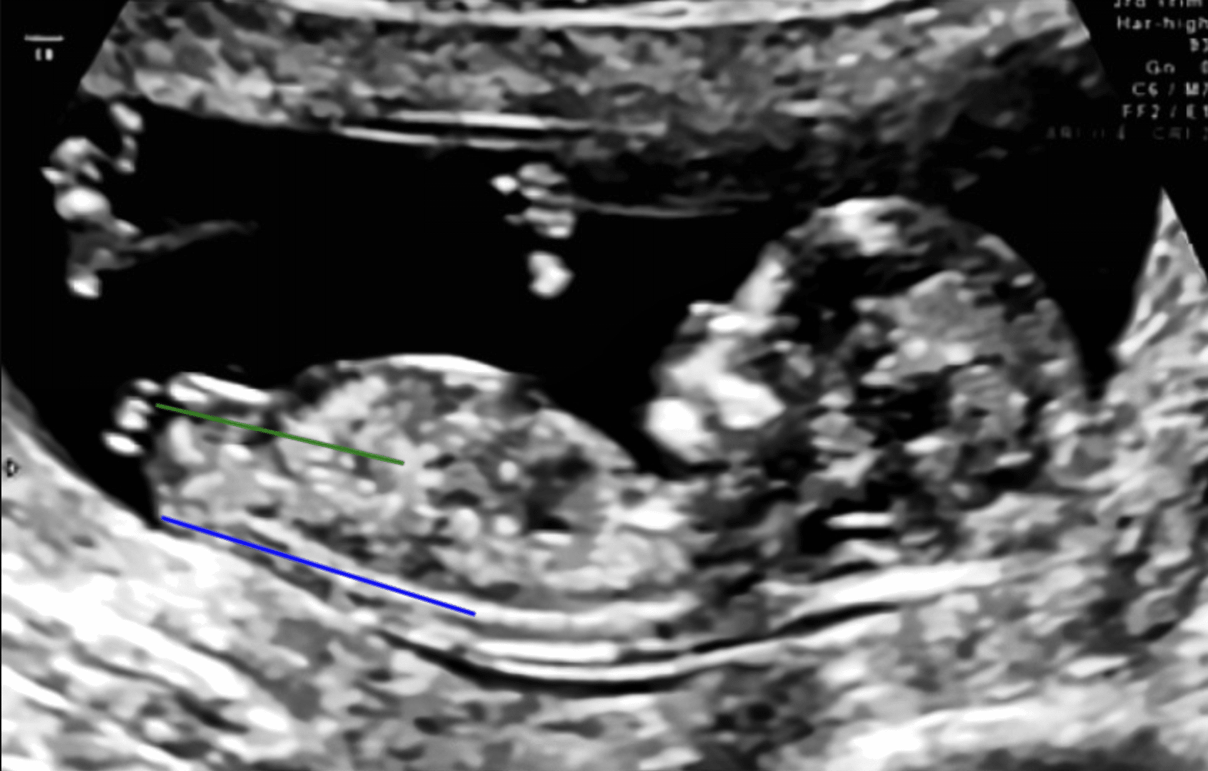 De nub-theorie: kun je zo het geslacht van je baby voorspellen?